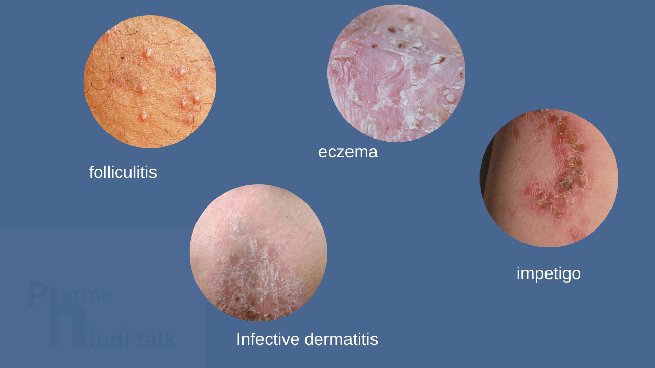 Framycetin Skin Cream Uses in Hindi: Face पर कैसे लगाएं, फायदे और Side ...